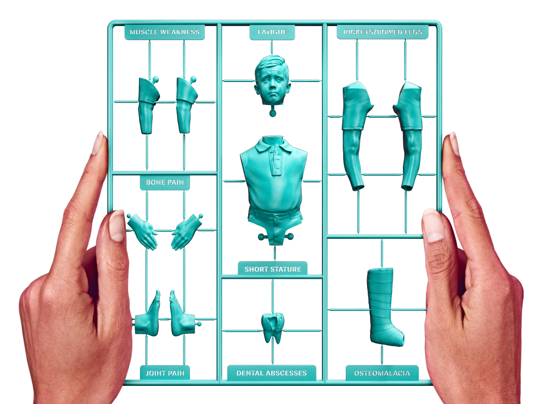 Symptoms of XLH in Children