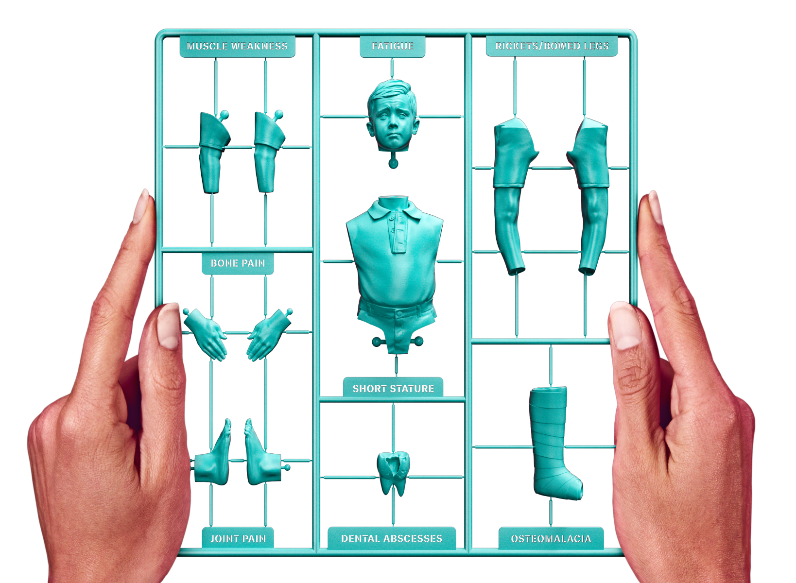 Symptoms of XLH in Children